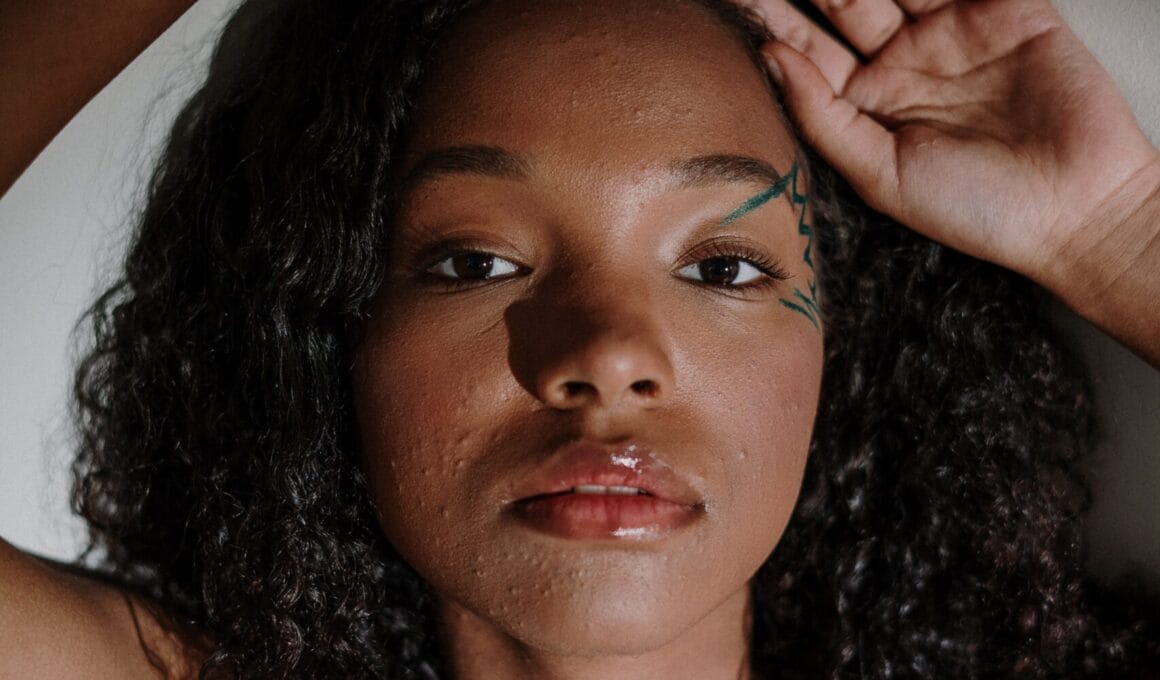 Introducing Acne Club